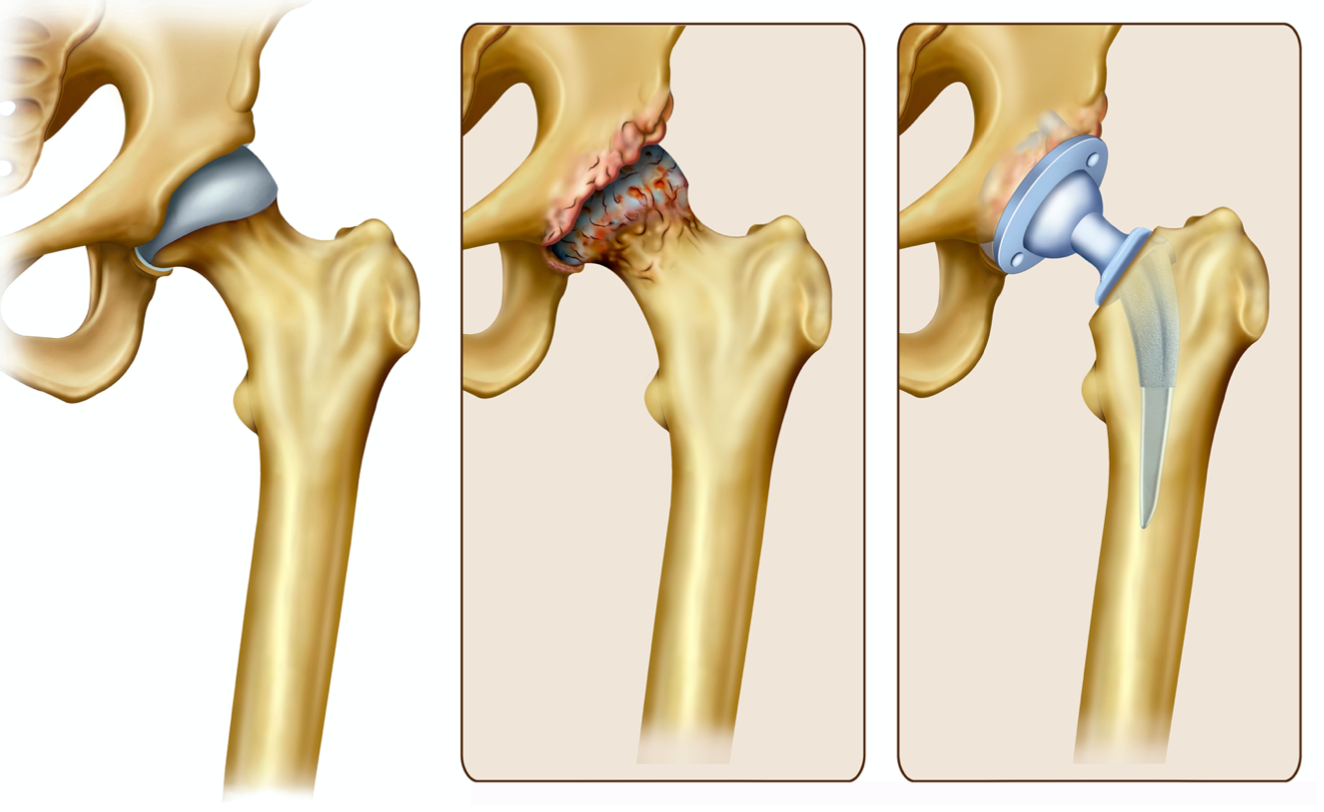 Cirugía de articulación de cadera - Dr. Elido Pérez